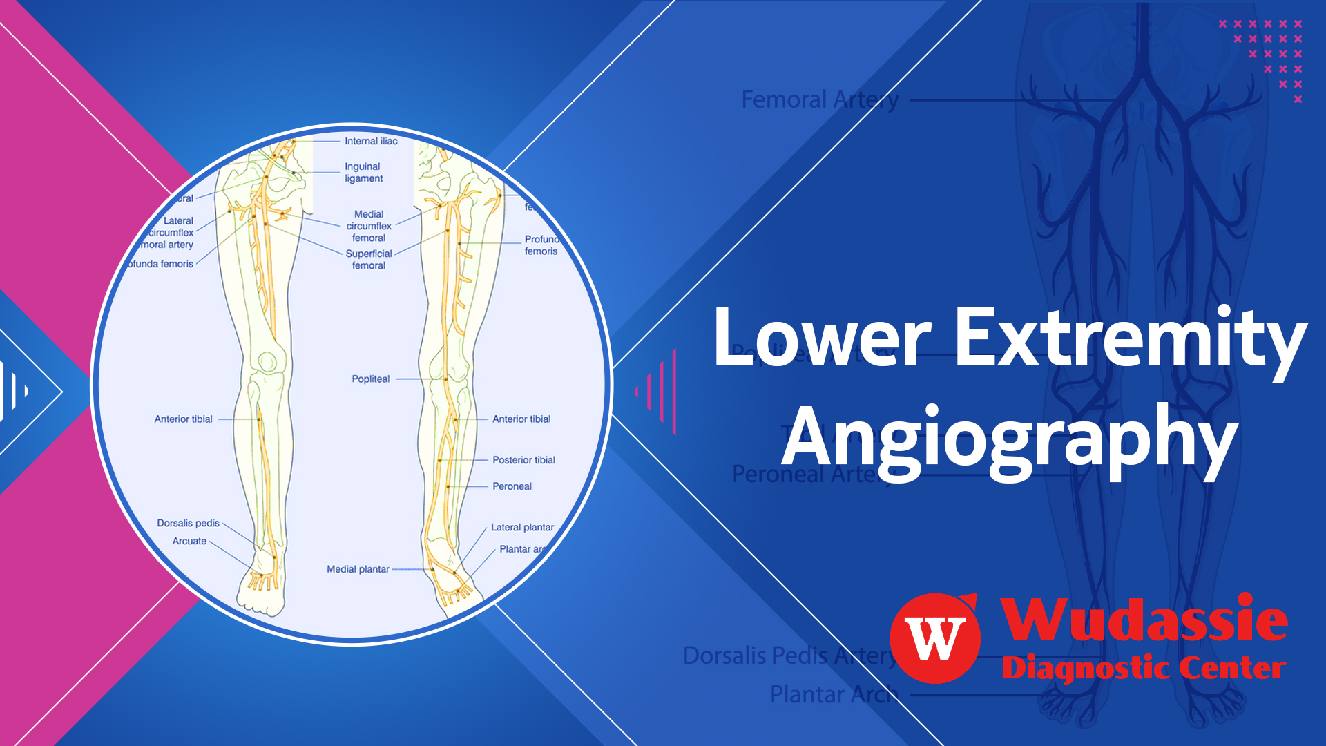 Lower Extremity Angiography – (ሎወር ኤክስትሪሚቲ አንጂዎግራፊ) – MOA Training
